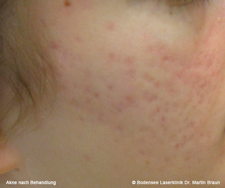 Erfolgreich Akne behandeln - Bodensee Laserklinik | Dr. Martin Braun ...