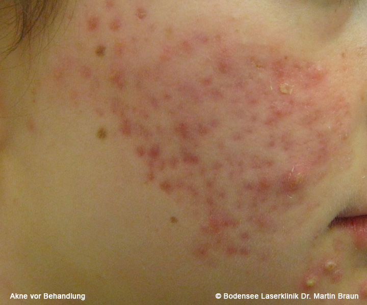 Erfolgreich Akne behandeln - Bodensee Laserklinik | Dr. Martin Braun ...