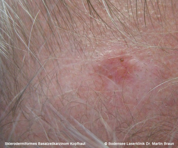 Basaliome durch zuviel UV-Strahlung - Bodensee Laserklinik | Dr. Martin ...